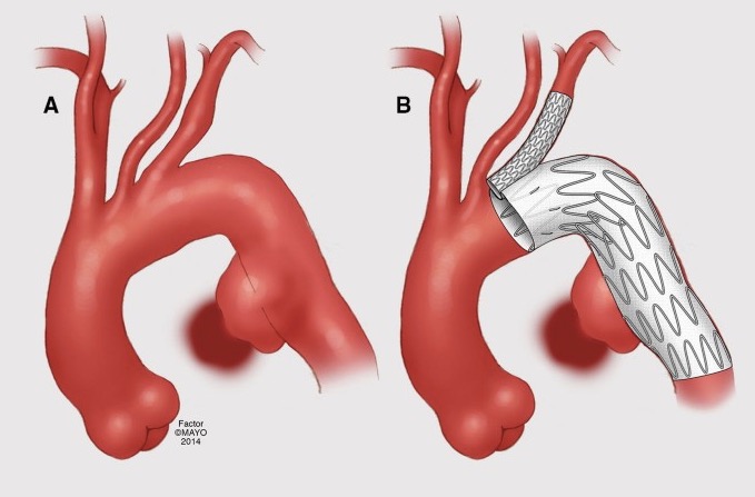 Penetrating Atherosclerotic Ulcers – Aortic Academy