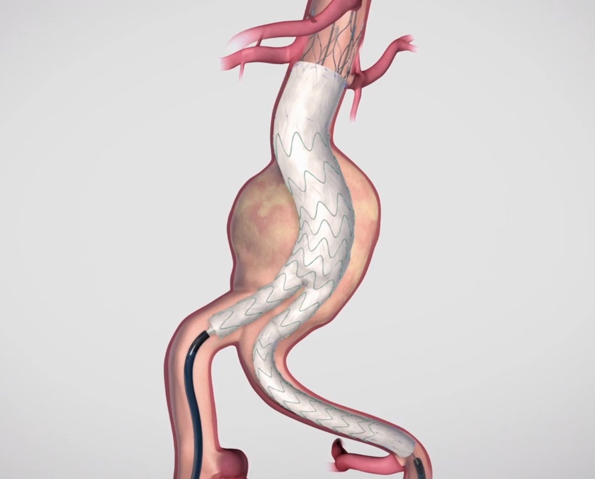 Aortic Aneurysms – Aortic Academy